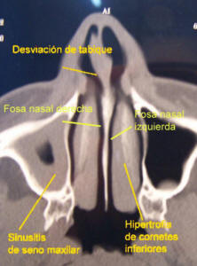 Obstrucción nasal y desviación de septum nasal